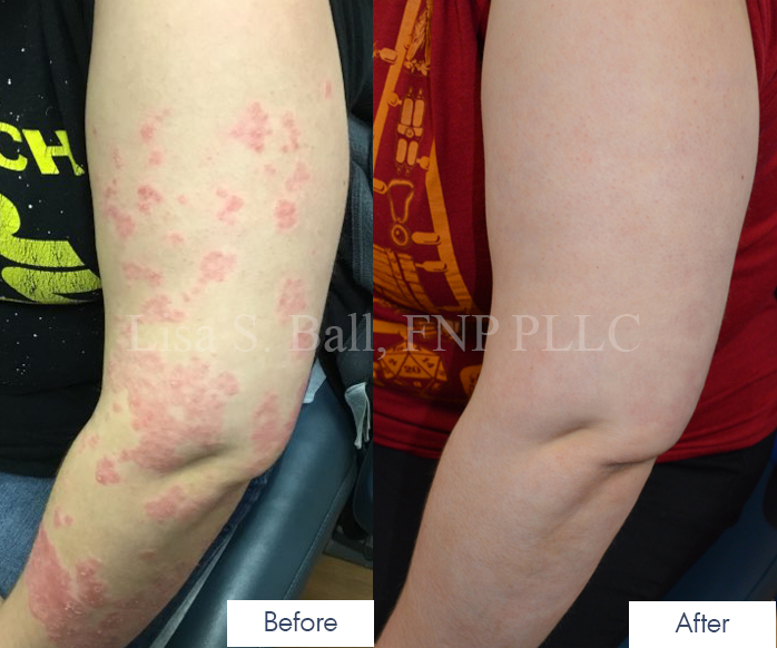 Biologics for Psoriasis | Lisa S. Ball, NP